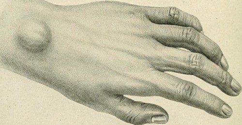 Common Hand Cysts & Tumors - Hand and Wrist Institute