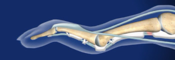 Swan Neck Deformity Surgery in Dallas, TX | Causes, Treatment