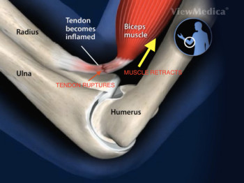 Biceps Tendon Injury | The Hand and Wrist Institute