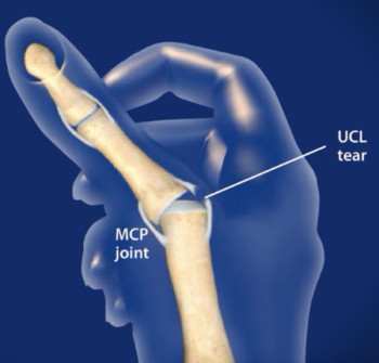 Gamekeeper's Thumb Symptoms & Treatment in Dallas, TX