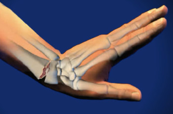 Colles Fracture: Treatment & Recovery Time